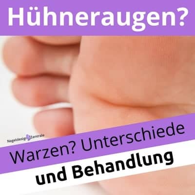 Hühnerauge oder Warze? Was ist der Unterschied – was hilft dagegen ...