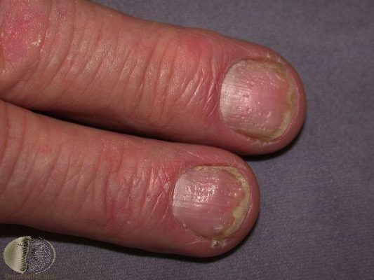 Dellen Im Fingernagel Bilder