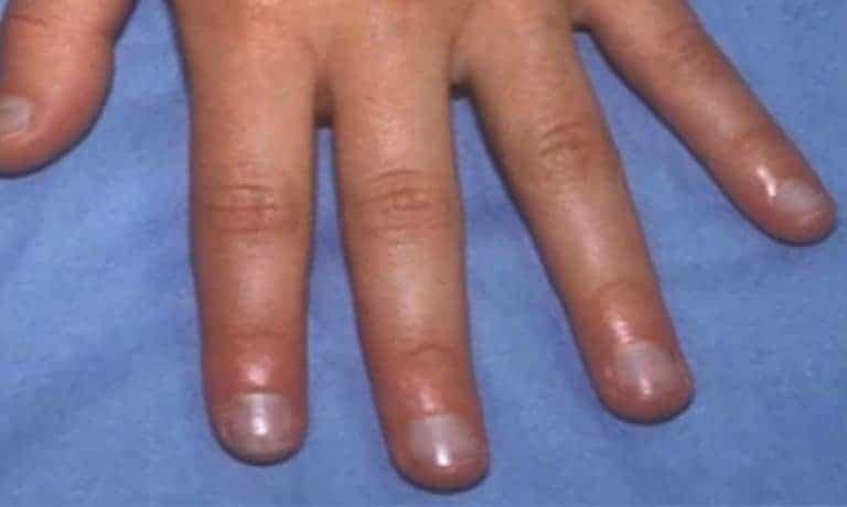 Blaue Fingernägel Ursachen und Behandlungen - Nageldesign Zentrale